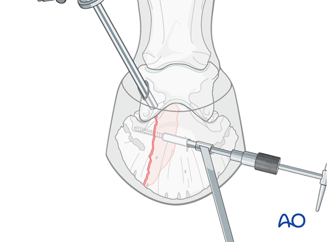 Screw fixation for Distal phalanx: Abaxial articular fractures