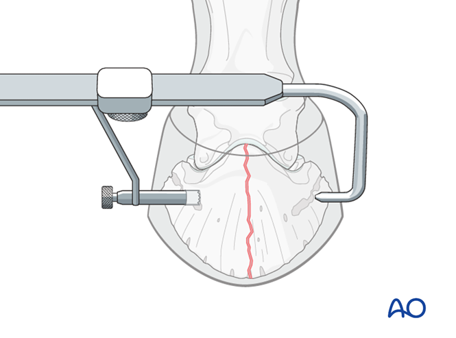Screw fixation for Distal phalanx: Sagittal and perisagittal fractures