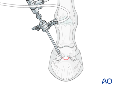 Resection for Distal phalanx: Extensor process fractures