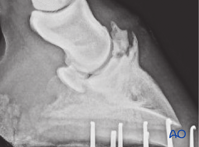 Distal phalanx: Extensor process fractures