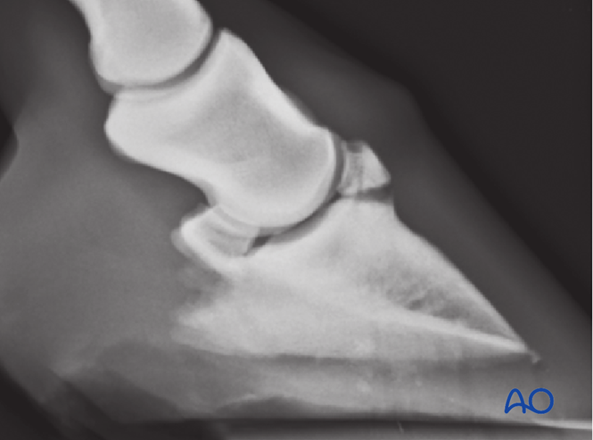 Resection for Distal phalanx: Extensor process fractures