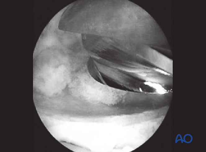 Resection for Distal phalanx: Extensor process fractures