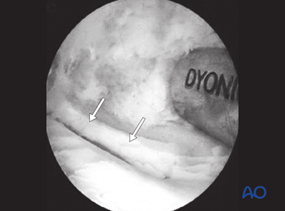 Resection for Distal phalanx: Extensor process fractures