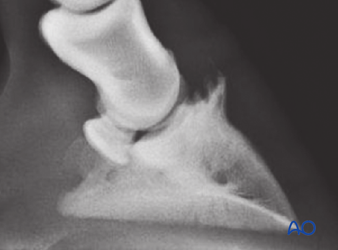 Resection for Distal phalanx: Extensor process fractures