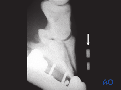 Resection for Distal phalanx: Extensor process fractures