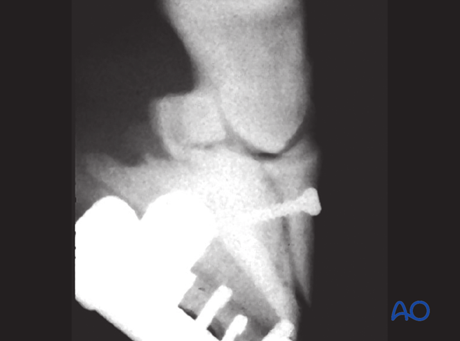 Resection for Distal phalanx: Extensor process fractures
