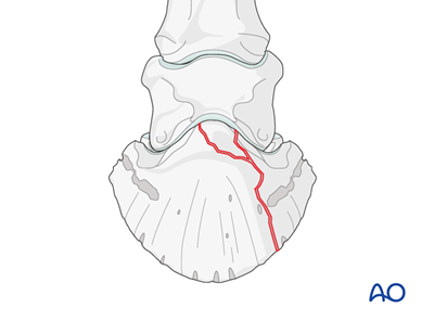 Distal phalanx: Multifragmentary fractures