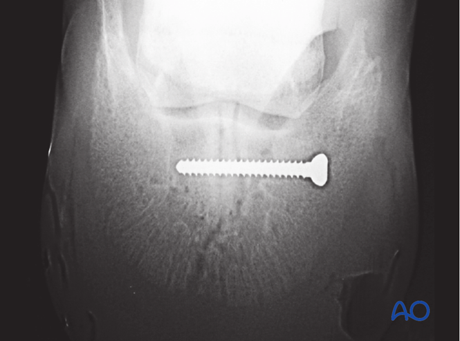 Screw fixation and resection for Distal phalanx: Multifragmentary fractures