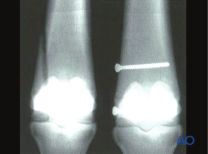 Metacarpal/-tarsal condyles: Description and preoperative considerations