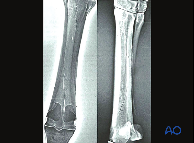 Metacarpal/-tarsal condyles: Description and preoperative considerations