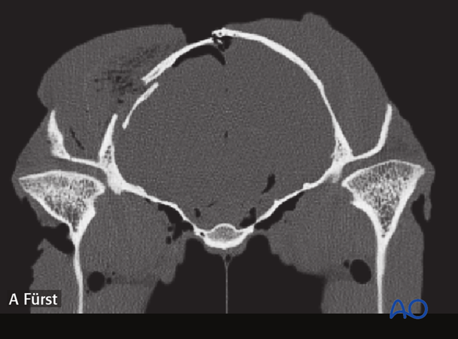 Fracture of the parietal bone
