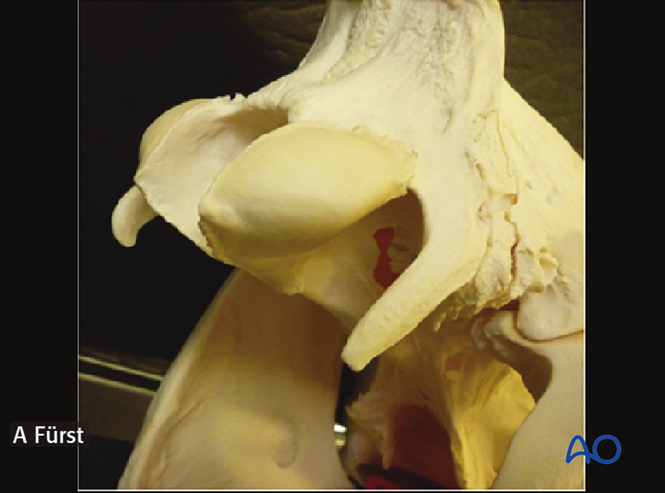 Fracture of the paracondylar process