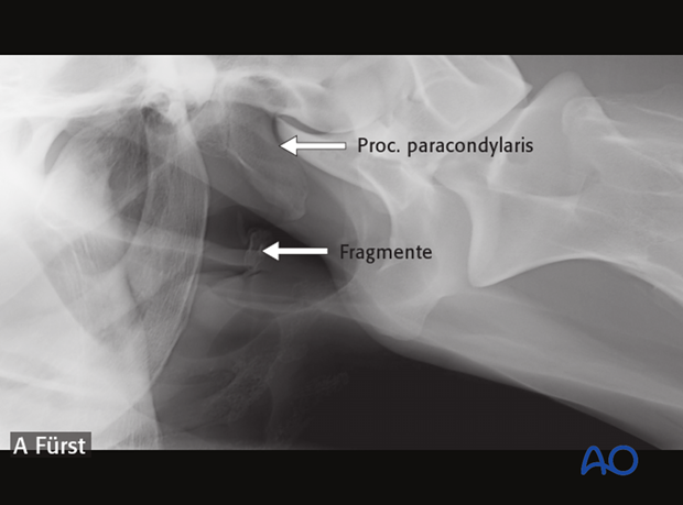Fracture of the paracondylar process