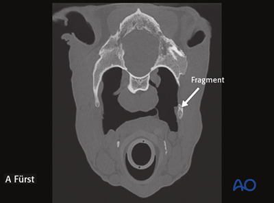 Fracture of the paracondylar process