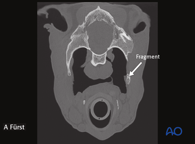 Fracture of the paracondylar process