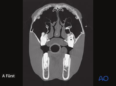 Suture periostitis