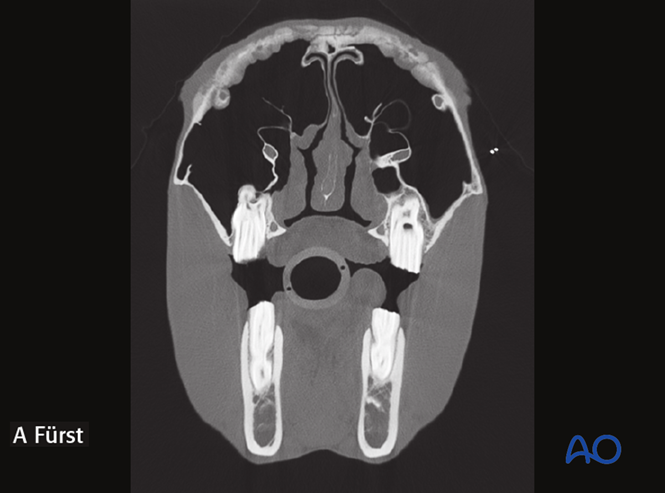 Suture periostitis