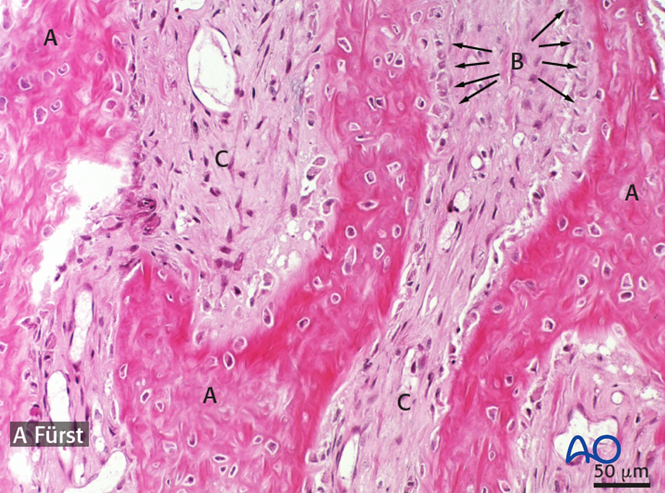 Suture periostitis