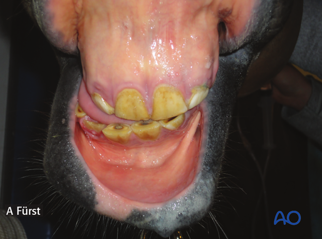 Bilateral fractures of the interdental space and horizontal ramus