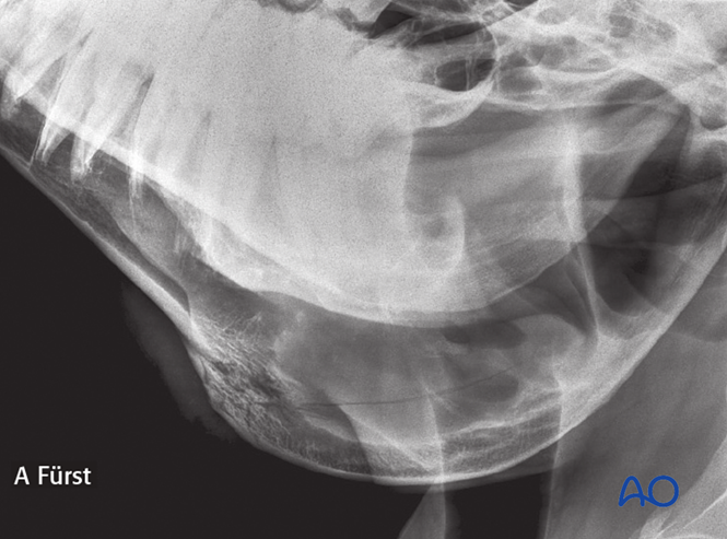 Nonsurgical fracture management for Fractures of the vertical ramus
