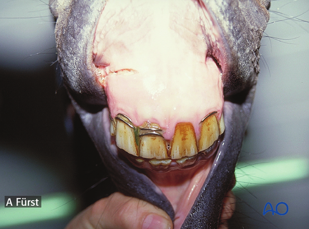 Wire fixation for Incisive bone fractures