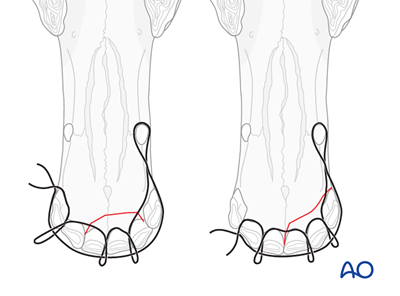 Wire fixation for Incisive bone fractures