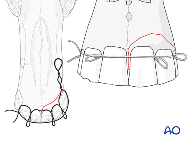Wire fixation for Incisive bone fractures