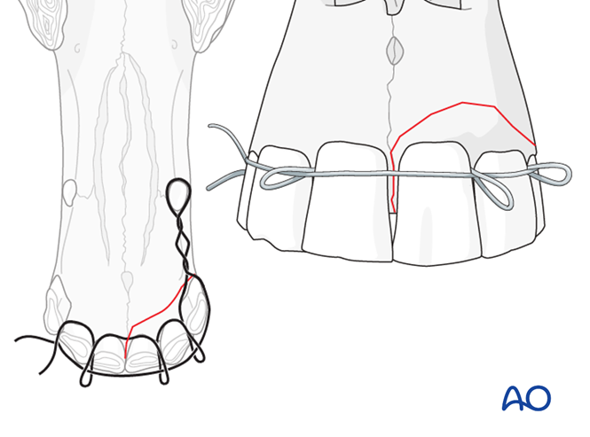 Wire fixation for Incisive bone fractures