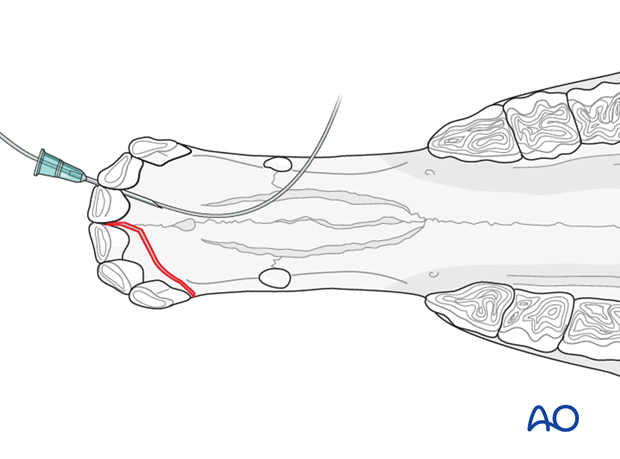 Wire fixation for Incisive bone fractures