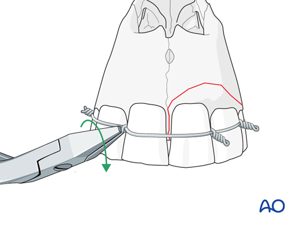 Wire fixation for Incisive bone fractures
