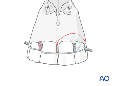 Wire fixation for Incisive bone fractures