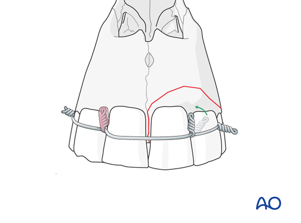 Wire fixation for Incisive bone fractures