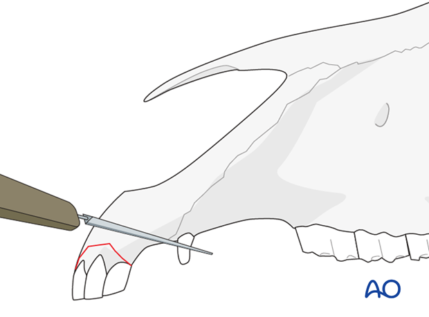 Wire fixation for Incisive bone fractures