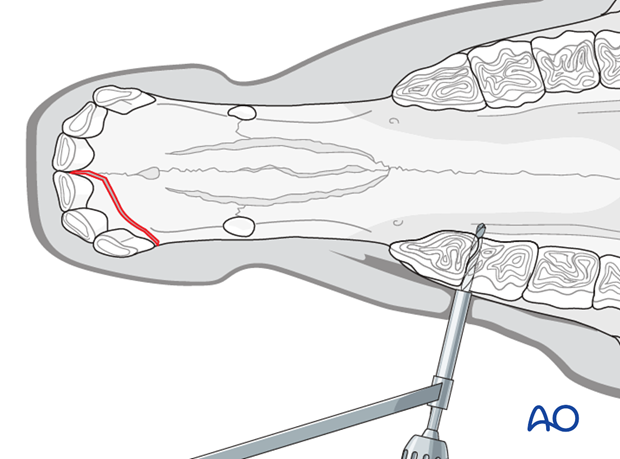 Wire fixation for Incisive bone fractures