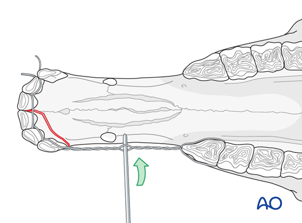Wire fixation for Incisive bone fractures