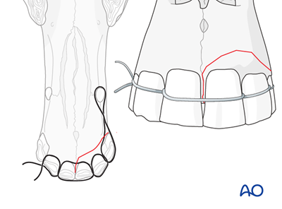 Wire fixation for Incisive bone fractures