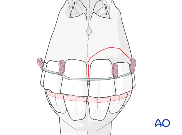 Wire fixation for Incisive bone fractures