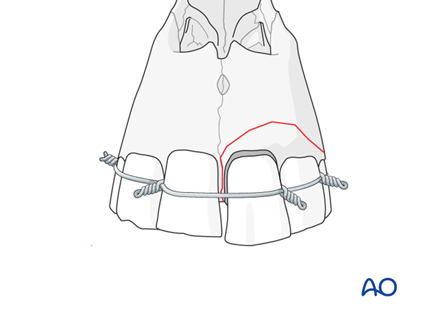 Wire fixation for Incisive bone fractures