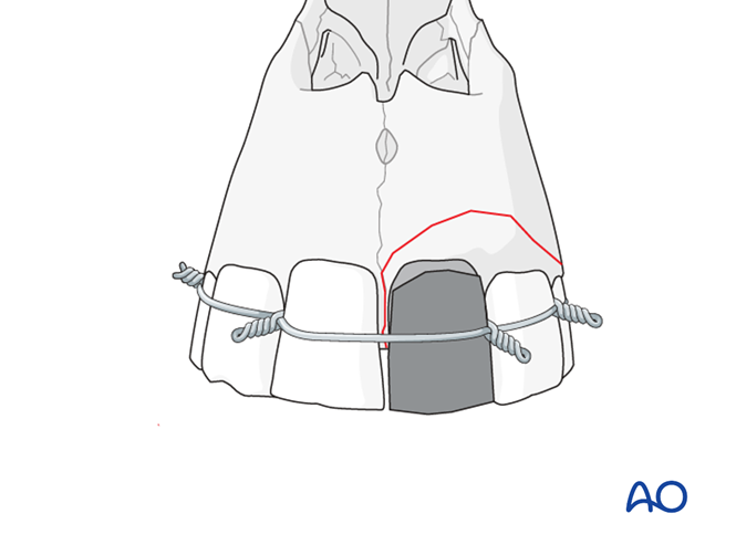 Wire fixation for Incisive bone fractures