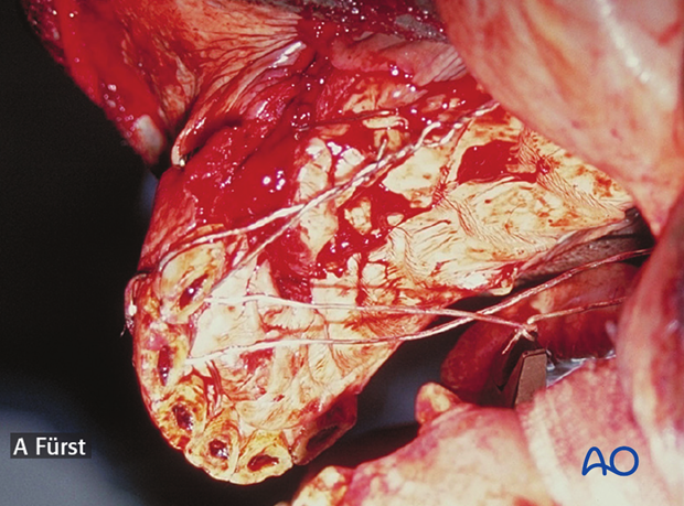 Wire fixation for Incisive bone fractures