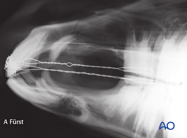 Wire fixation for Incisive bone fractures