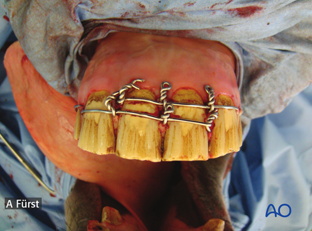 Wire fixation for Incisive bone fractures
