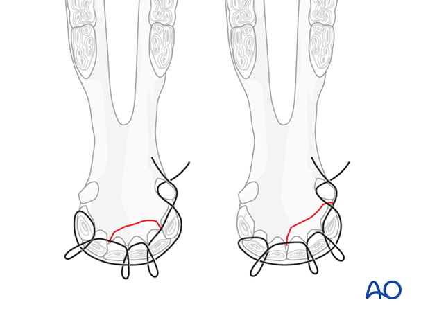 Wire fixation for Unilateral rostral fractures