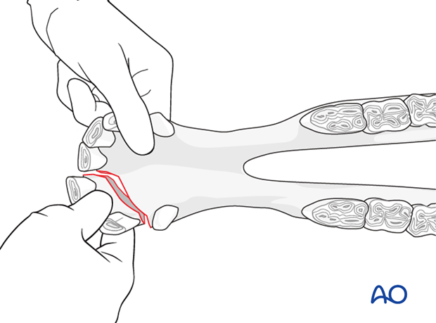 Wire fixation for Unilateral rostral fractures