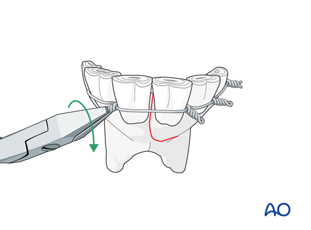 Wire fixation for Unilateral rostral fractures