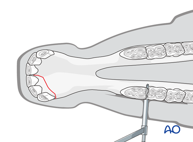 Wire fixation for Unilateral rostral fractures