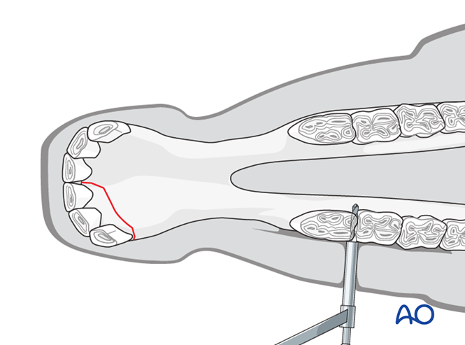 Wire fixation for Unilateral rostral fractures