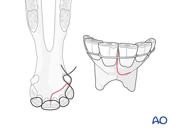 Wire fixation for Unilateral rostral fractures