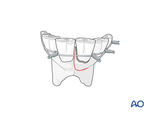 Wire fixation for Unilateral rostral fractures