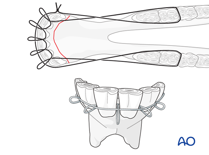 Wire fixation for Bilateral rostral fractures